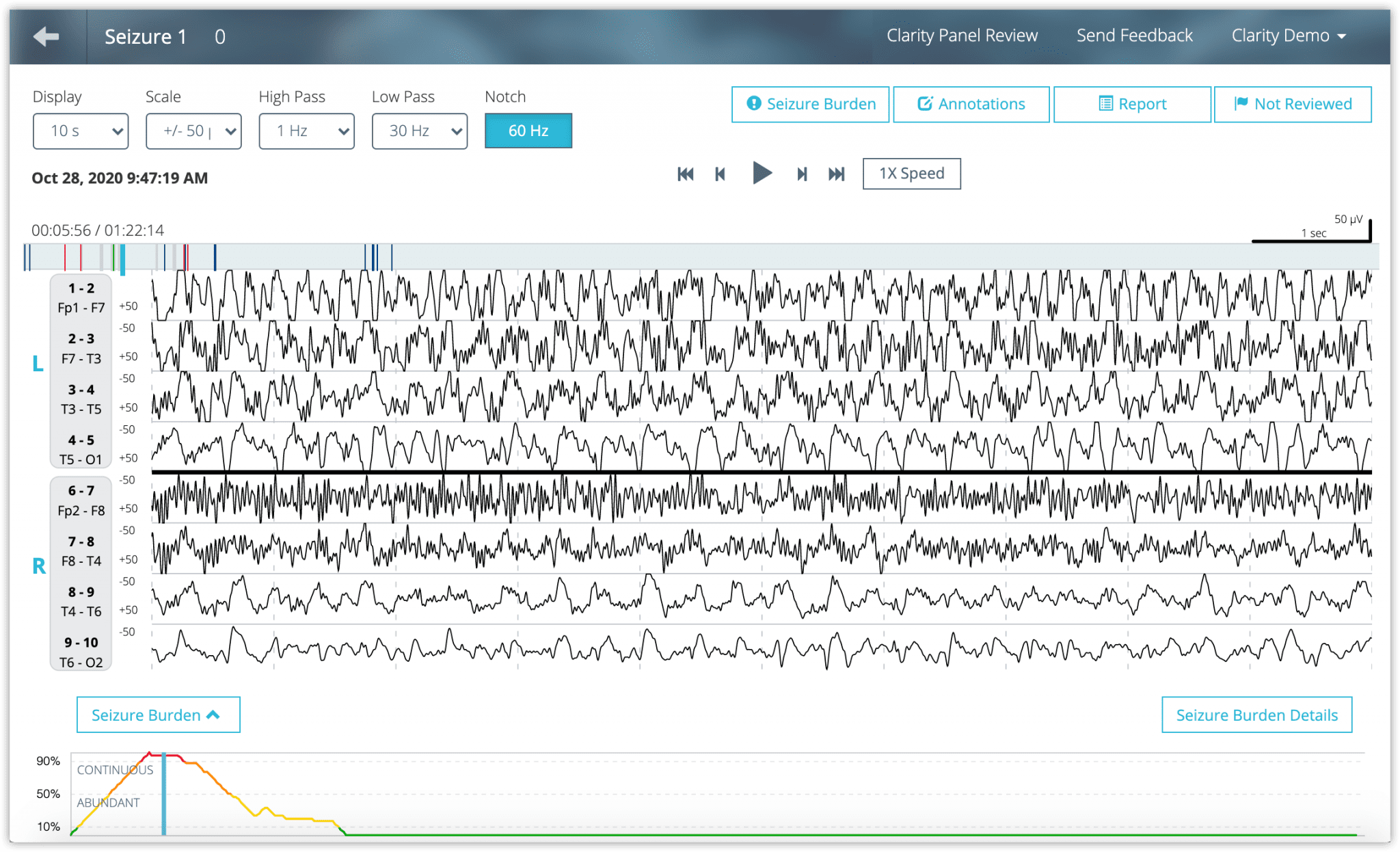 Ceribell Clarity for 24/7 EEG seizure burden monitoring - Ceribell