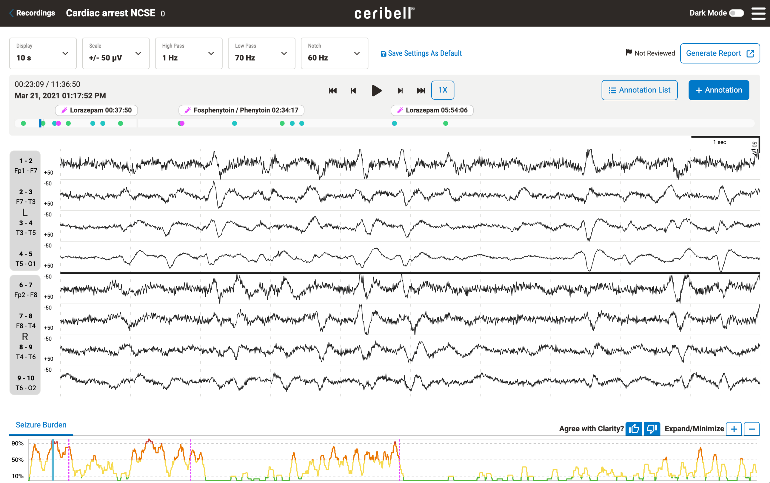 Ceribell Clarity for 24/7 EEG seizure burden monitoring - Ceribell